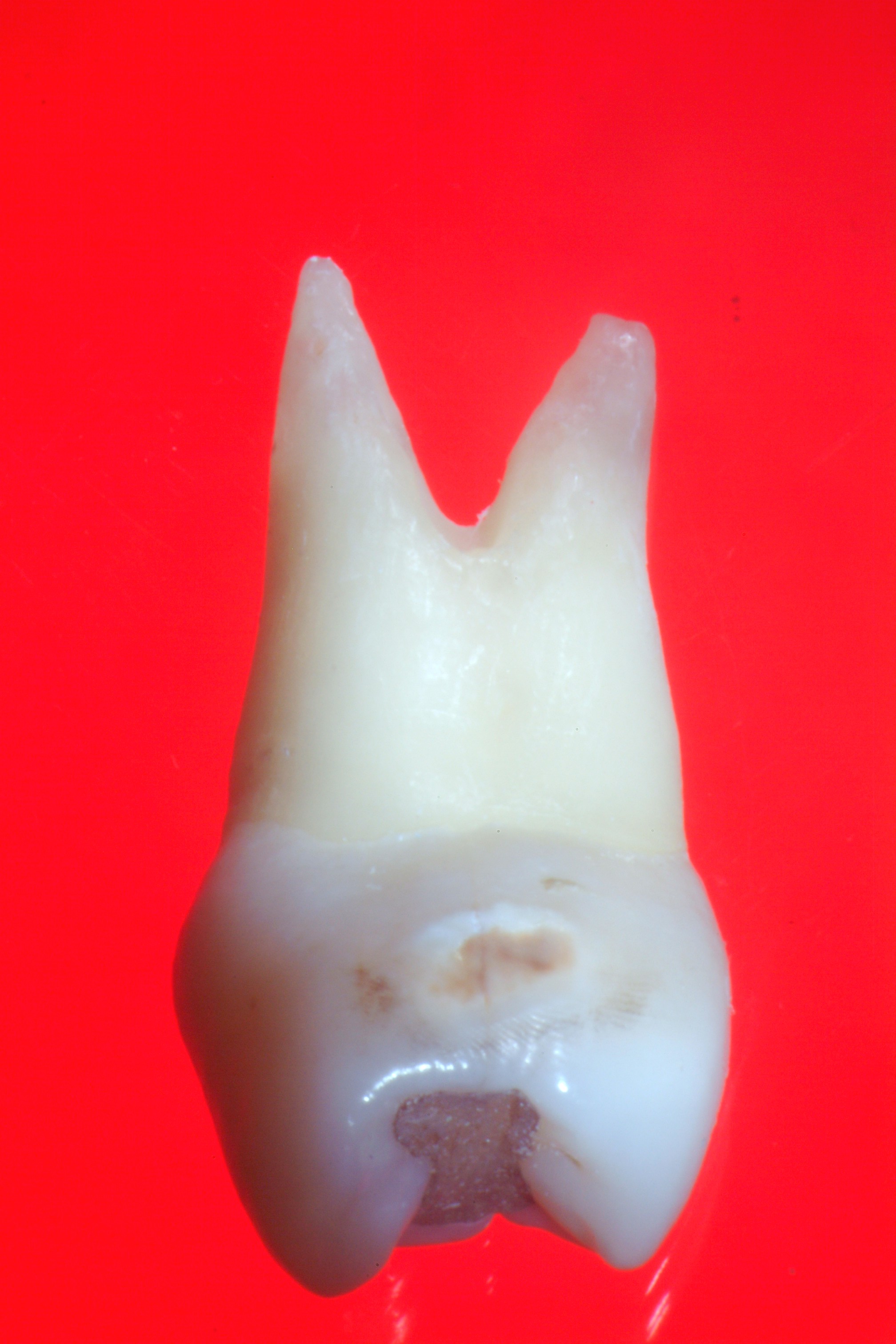 Buccal root of the bifurcated maxillary premolar—a danger zone during ...