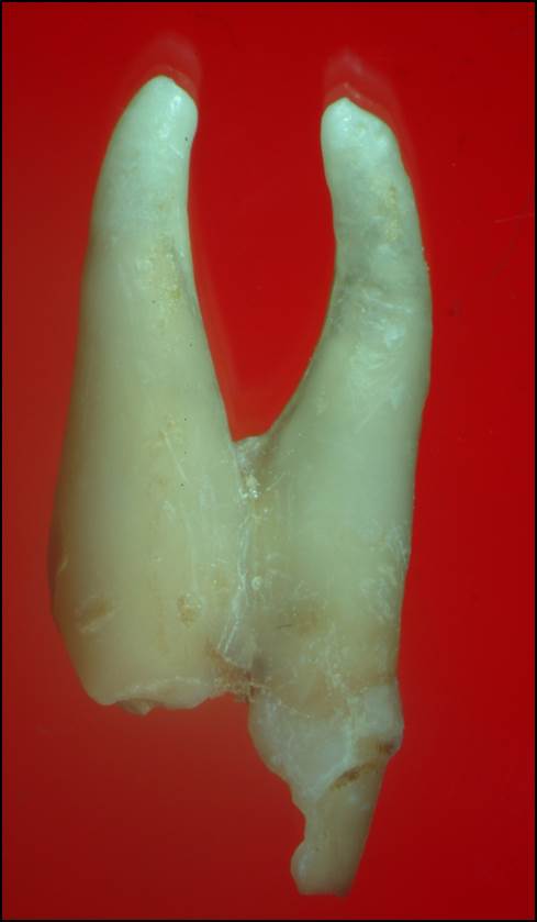 Buccal root of the bifurcated maxillary premolar—a danger zone during ...