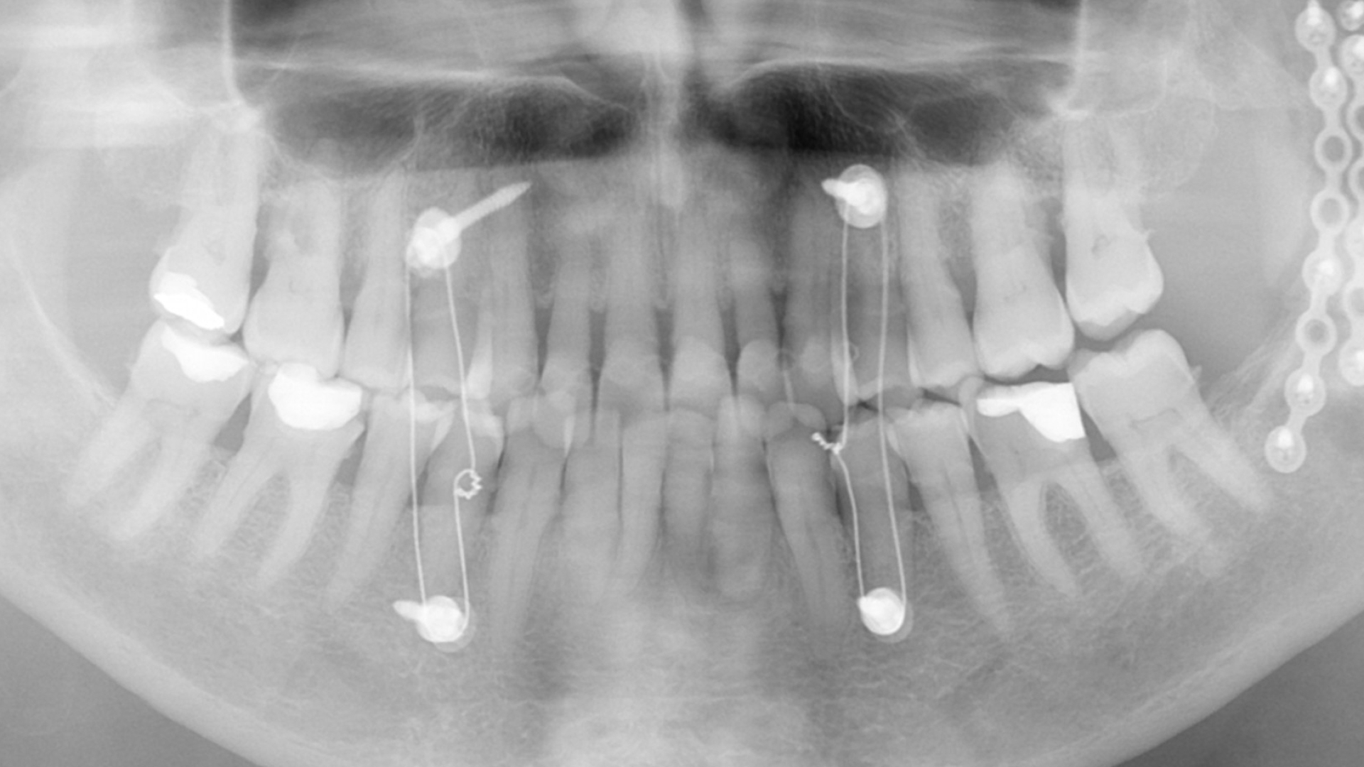 Dental News - Unilateral occlusal elevation with a lithium disilicate ...