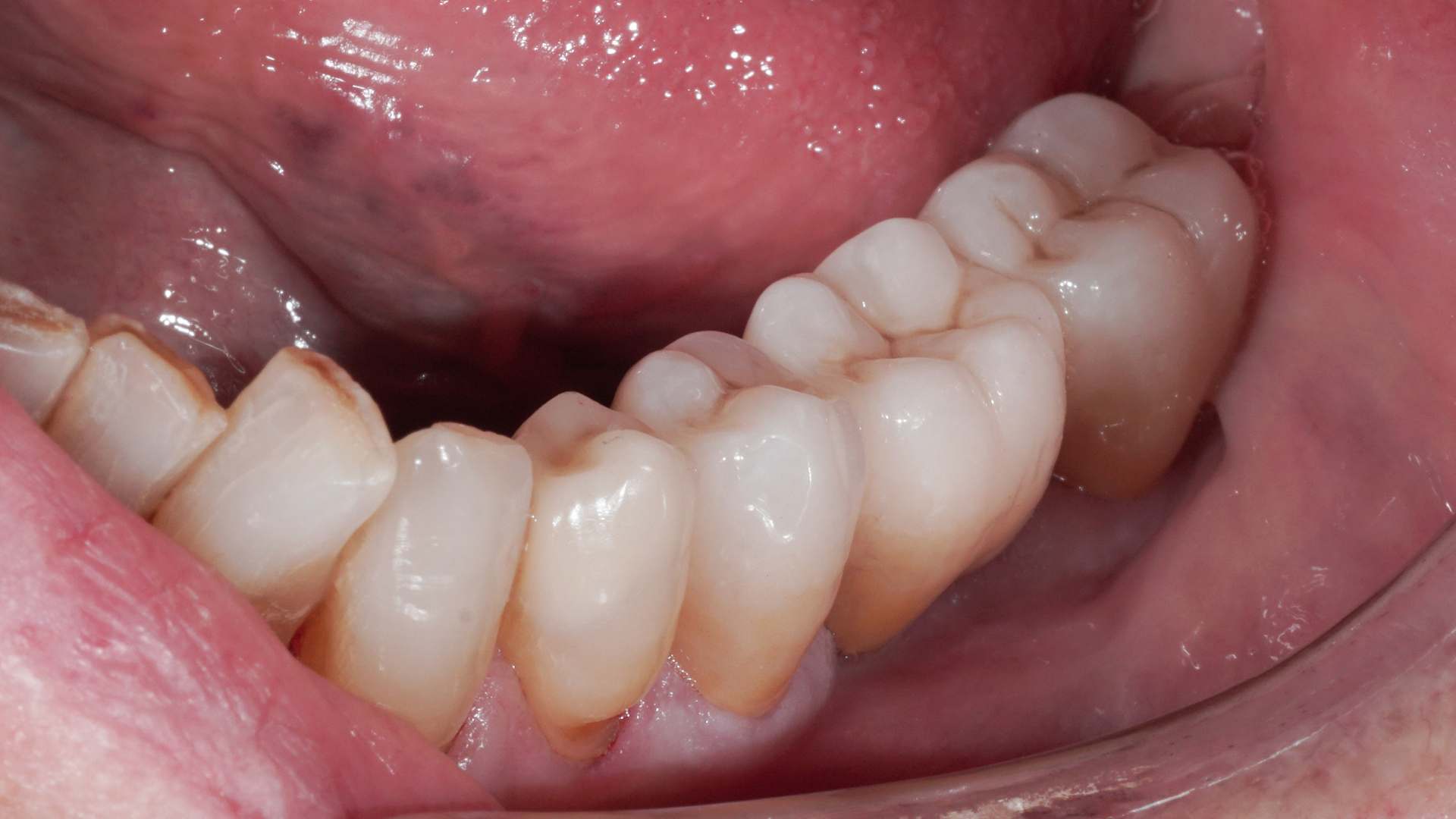 Dental News - Unilateral occlusal elevation with a lithium disilicate ...