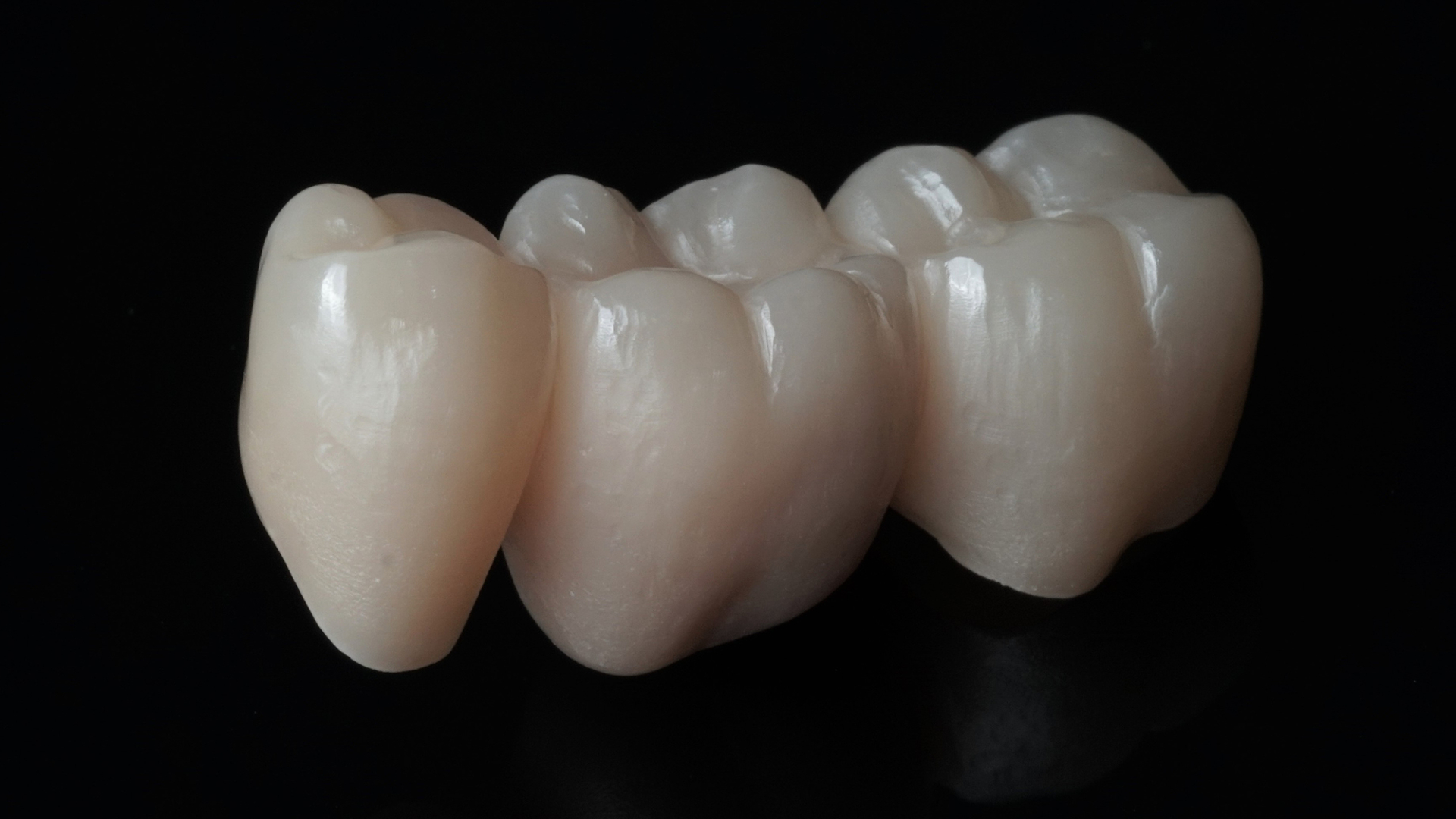 Dental News - Unilateral occlusal elevation with a lithium disilicate ...